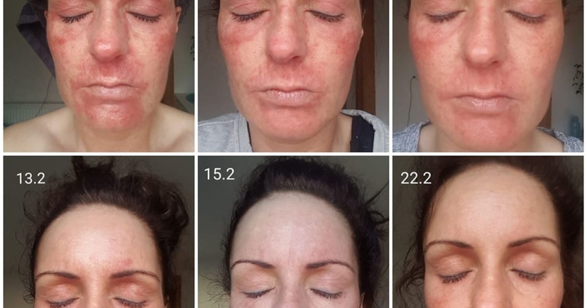 Chronic acne | LAVYcosmetics